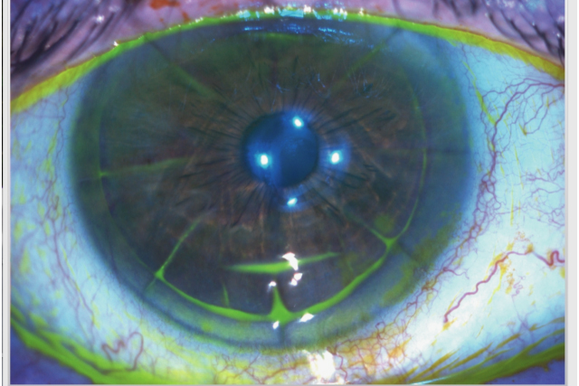 Dr. Edward Boshnick - LASIK Complications & Scleral Lenses