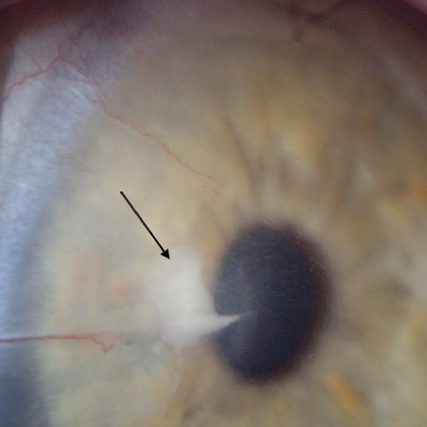 Dr. Edward Boshnick - LASIK Complications & Scleral Lenses