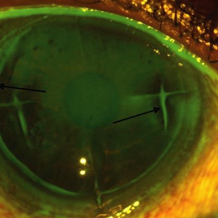 Dr. Edward Boshnick - LASIK Complications & Scleral Lenses